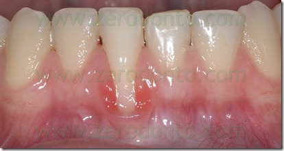 Scared of flared teeth : r/braces